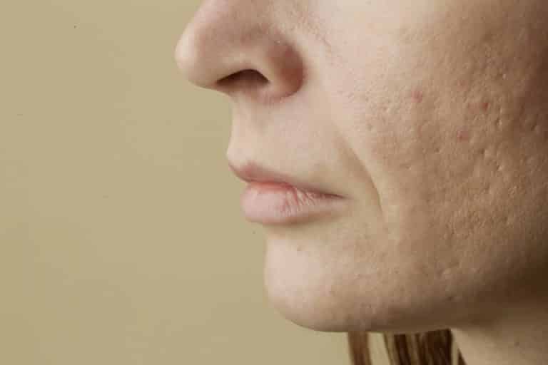 Pockmarks: What are these marks on face? Removal and Prevention