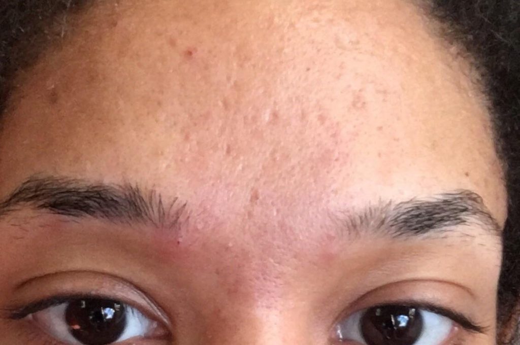 Pockmarks: What are these marks on face? Removal and Prevention