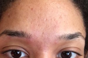 Pockmarks: What are these marks on face? Removal and Prevention