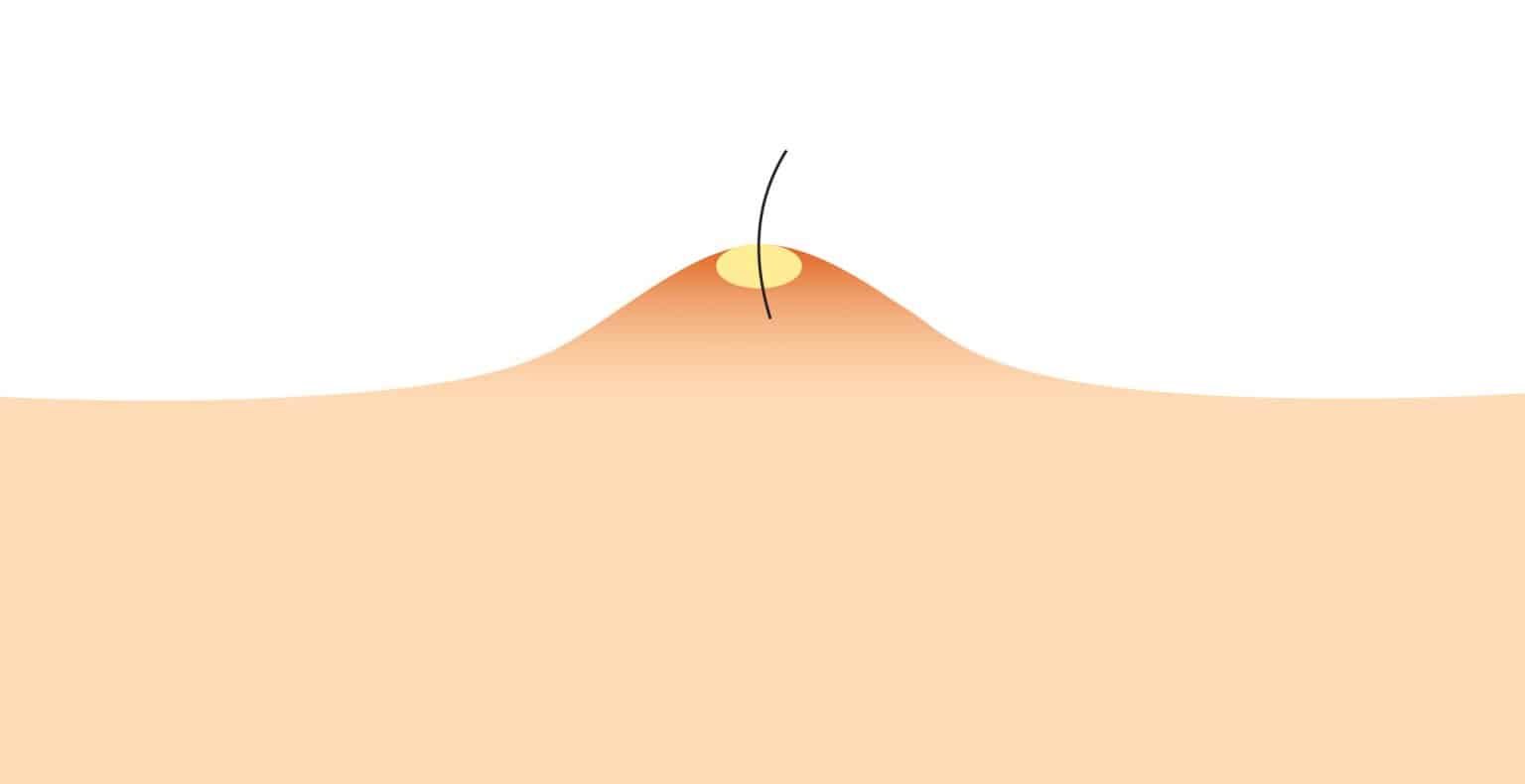 Carbuncles: How to treat them?