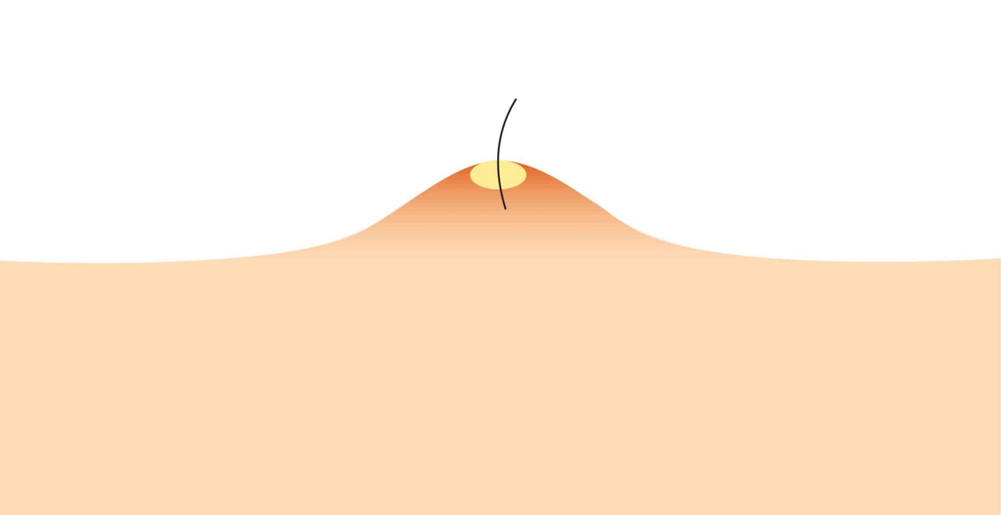 Carbuncles: How to treat them?